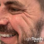 Botox® Summer Specials | LightTouch Med Spa