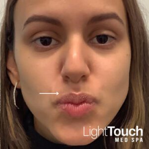 Botox® Summer Specials | LightTouch Med Spa