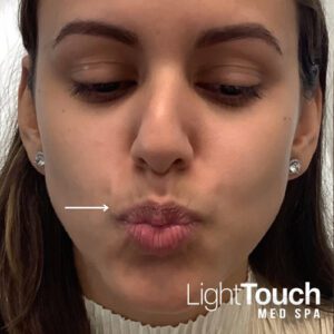 Botox® Summer Specials | LightTouch Med Spa
