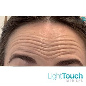 Botox® Summer Specials | LightTouch Med Spa