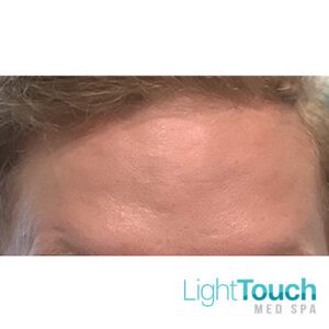 Botox® Summer Specials | LightTouch Med Spa