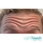 Botox® Summer Specials | LightTouch Med Spa