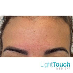 Botox® Summer Specials | LightTouch Med Spa