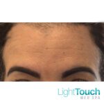 Botox® Summer Specials | LightTouch Med Spa