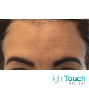 Botox® Summer Specials | LightTouch Med Spa