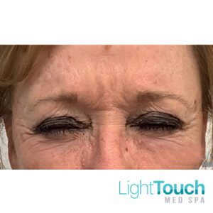 Botox® Summer Specials | LightTouch Med Spa