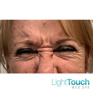 Botox® Summer Specials | LightTouch Med Spa