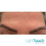 Botox® Summer Specials | LightTouch Med Spa