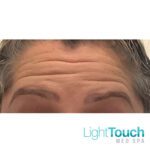Botox® Summer Specials | LightTouch Med Spa