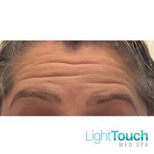 Botox® Summer Specials | LightTouch Med Spa