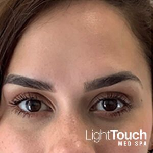 Botox® Summer Specials | LightTouch Med Spa