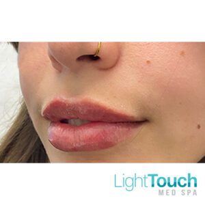 Botox® & Filler Summer Specials (Main) | LightTouch Med Spa
